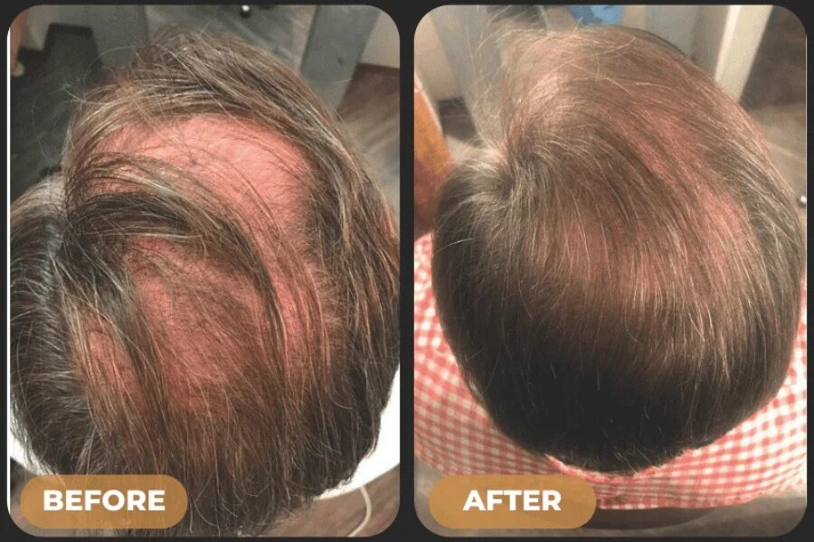 How Shampoo for Male Hair Growth Helps Prevent Hair Loss